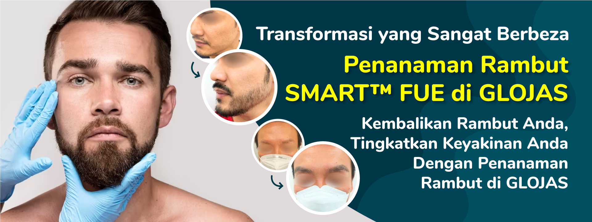 Klinik Tanam Rambut Di Malaysia | GLOJAS #1 Klinik Di Malaysia