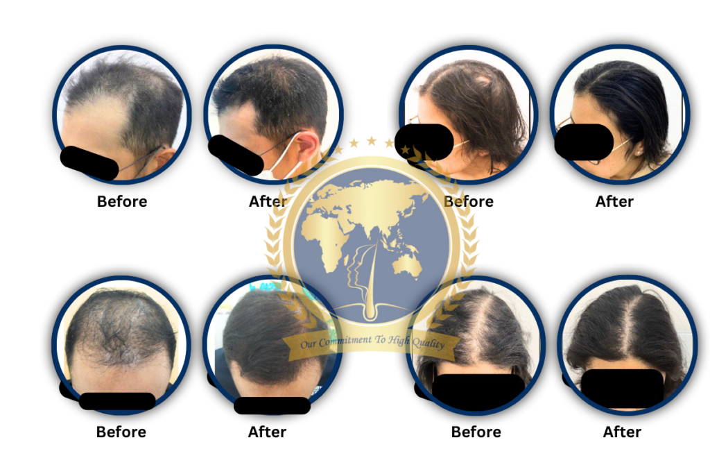 Prosedur Penanaman Rambut | Pakar Rambut Di GLOJAS