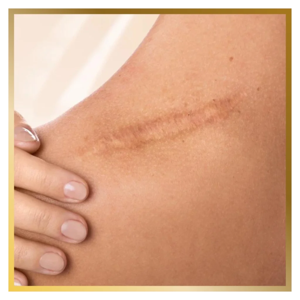 Scar Removal | Expert Treatments For Smooth, Clear Skin